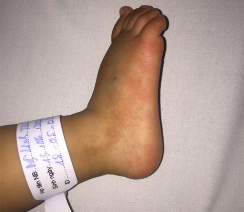 Bé bị nổi mẩn đỏ ở lòng bàn chân và những điều các mẹ nên biết