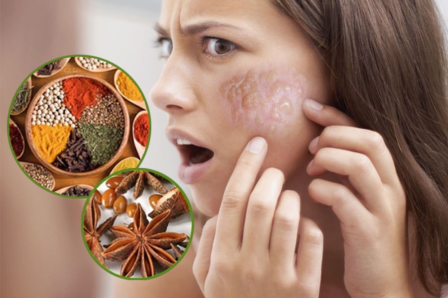 Chàm tổ đỉa - Đánh bay triệu chứng khó chịu với bài thuốc thảo dược