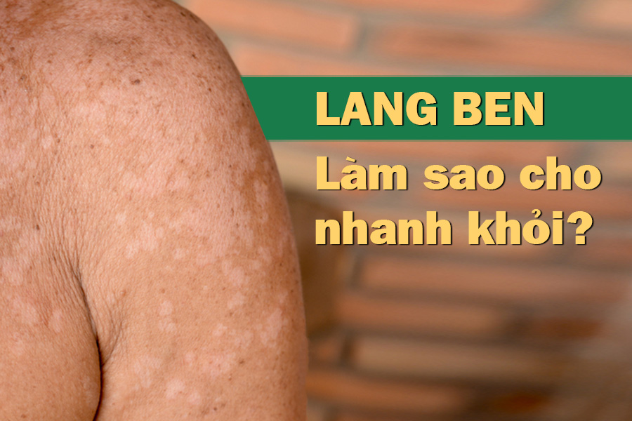 Các loại thuốc bôi lang ben hiệu quả được bán ở hiệu thuốc