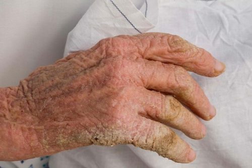 Cái Ghẻ Là Con Gì? Gây Bệnh Gì? Thông Tin Cần Biết - Thuốc dân tộc