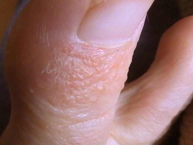 Tổ Đỉa Chàm Dạng Trứng Sam: Nguyên Nhân và Cách Trị