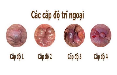 Trĩ Ngoại Độ 3 Là Như Thế Nào? Hình Ảnh Nhận Biết & Điều Trị