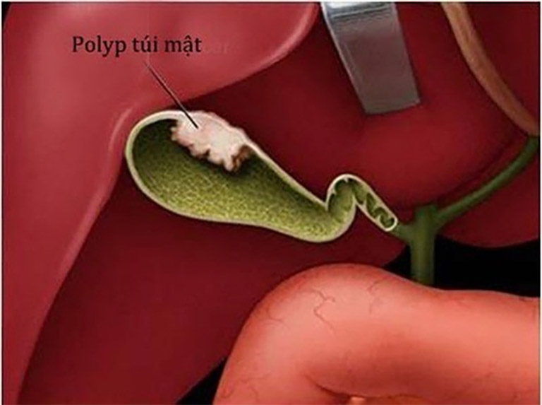 Polyp túi mật 6mm có nguy hiểm không?