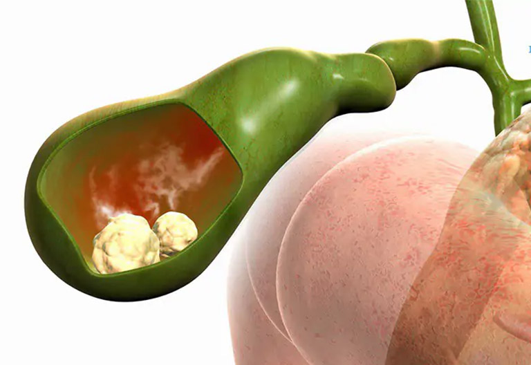 Polyp túi mật 8mm có lớn quá không? Cần phải làm gì?